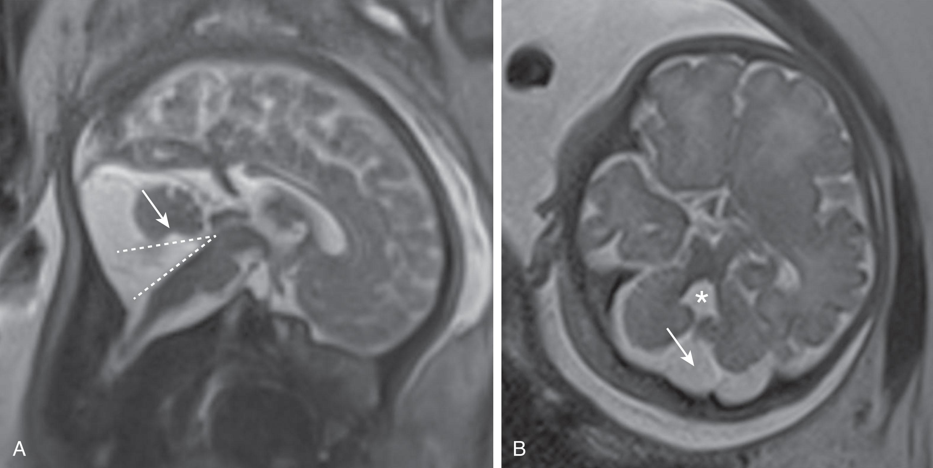 Normal and Abnormal Development of the Posterior Fossa Structures ...