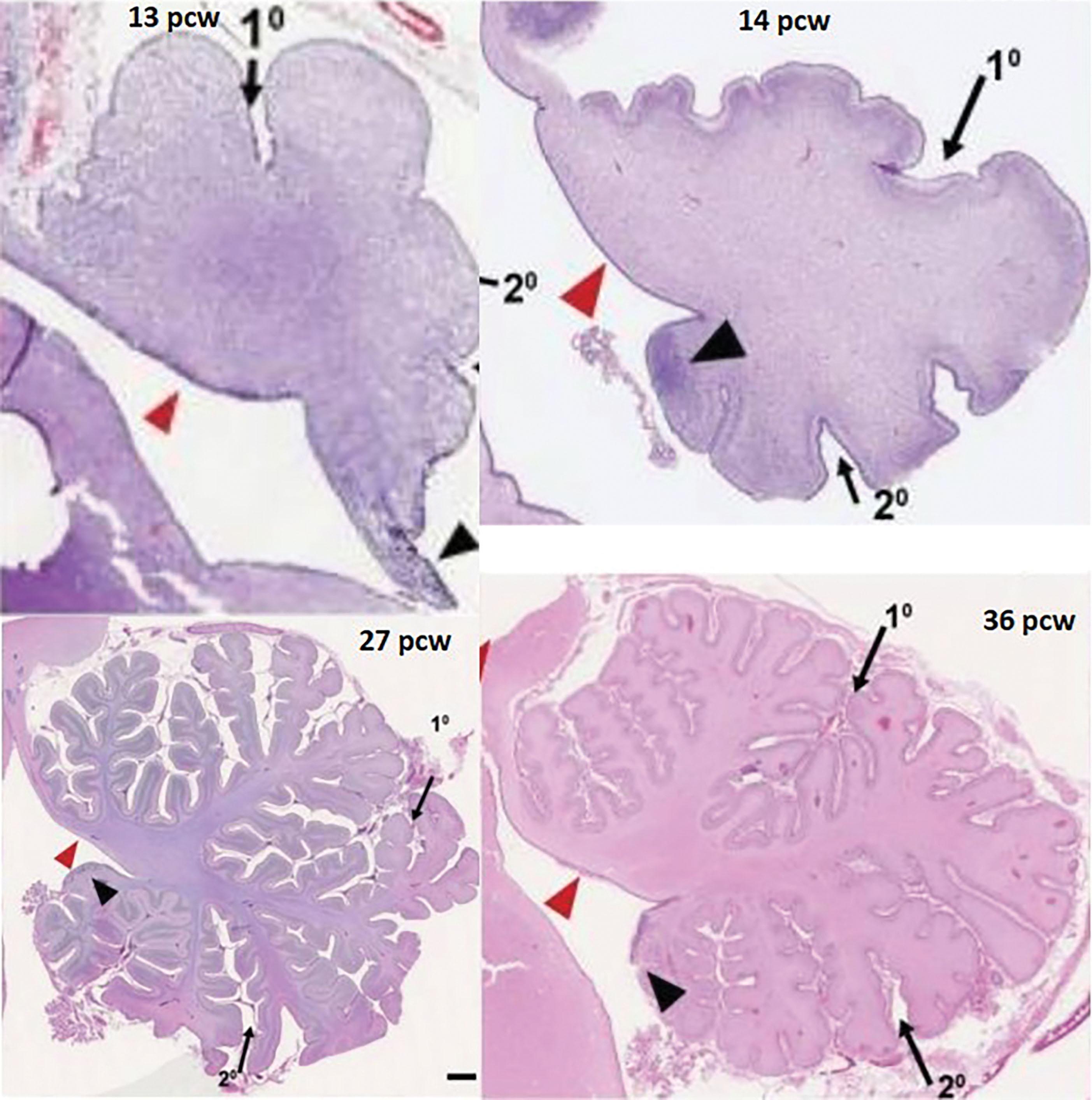 Normal and Abnormal Development of the Posterior Fossa Structures ...
