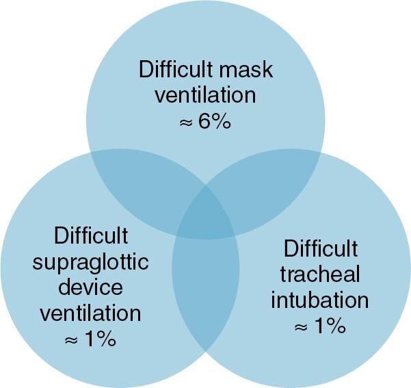 Normal and difficult airway management - Clinical Tree
