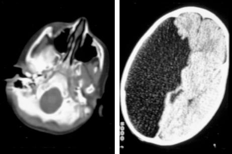 Obstetric Procedure–Related Defects : Early Chorionic Villus Sampling ...