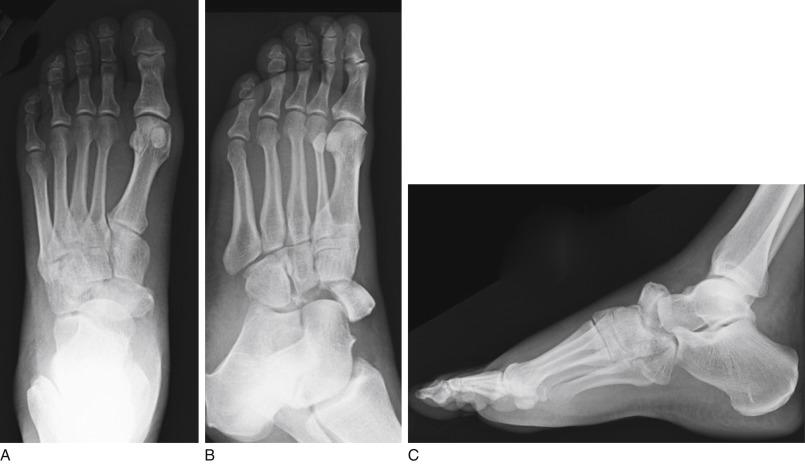 Open Reduction and Internal Fixation of Navicular and Cuboid Fractures ...