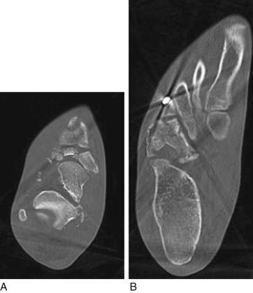 Open Reduction and Internal Fixation of Navicular and Cuboid Fractures ...