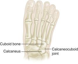Open Reduction and Internal Fixation of Navicular and Cuboid Fractures ...
