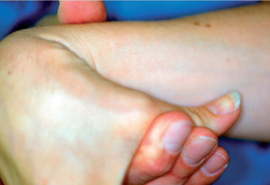 Open repair of multidirectional shoulder instability - Clinical Tree