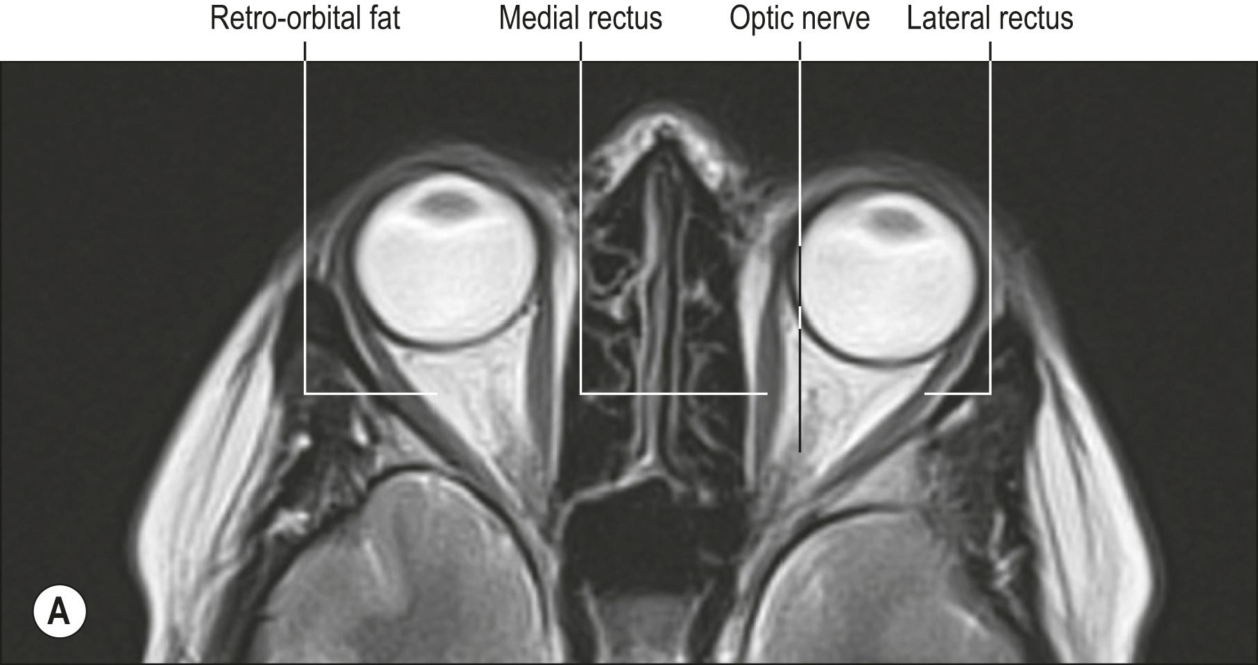 Orbit and accessory visual apparatus - Clinical Tree