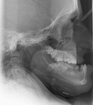 Osteogenesis Imperfecta - Clinical Tree