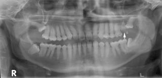 Osteogenesis Imperfecta - Clinical Tree