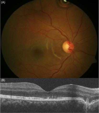 Other Choroidal Disorders - Clinical Tree