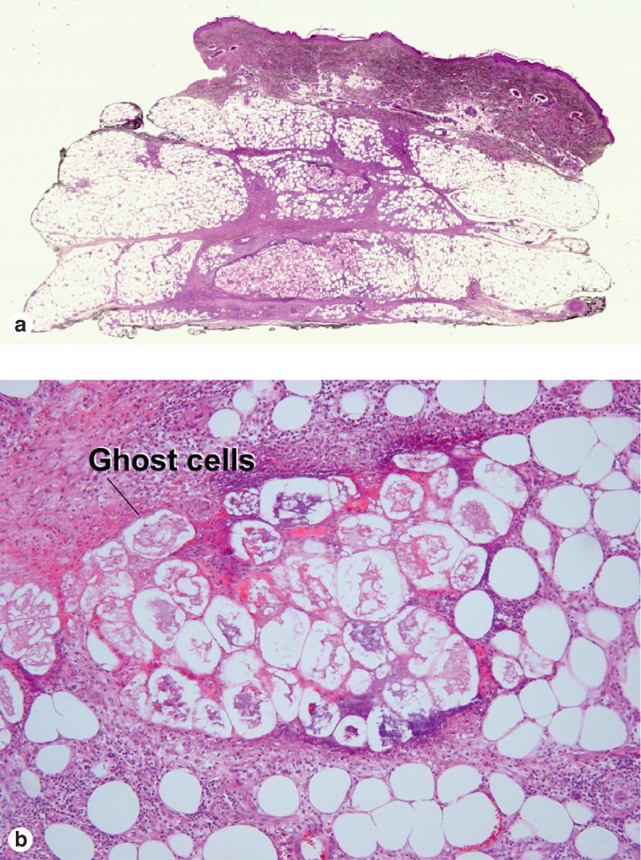 Panniculitis – Clinical Tree