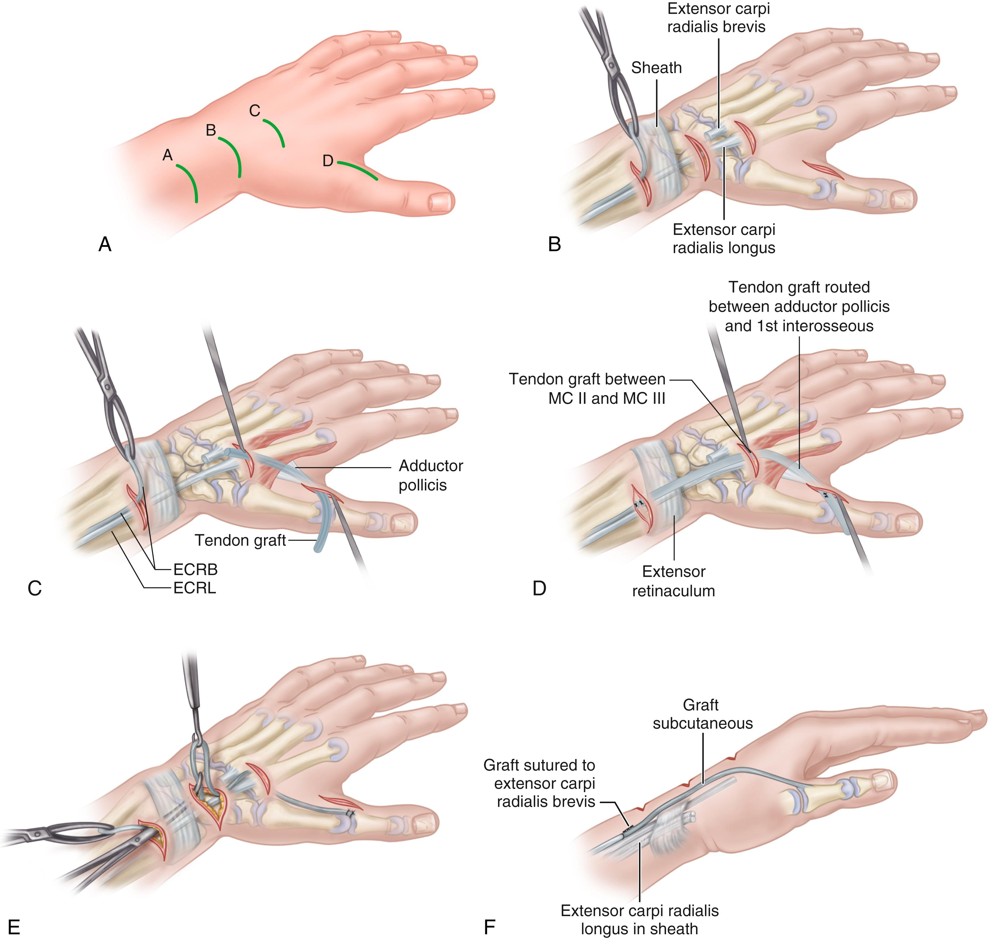 Paralytic Hand - Clinical Tree