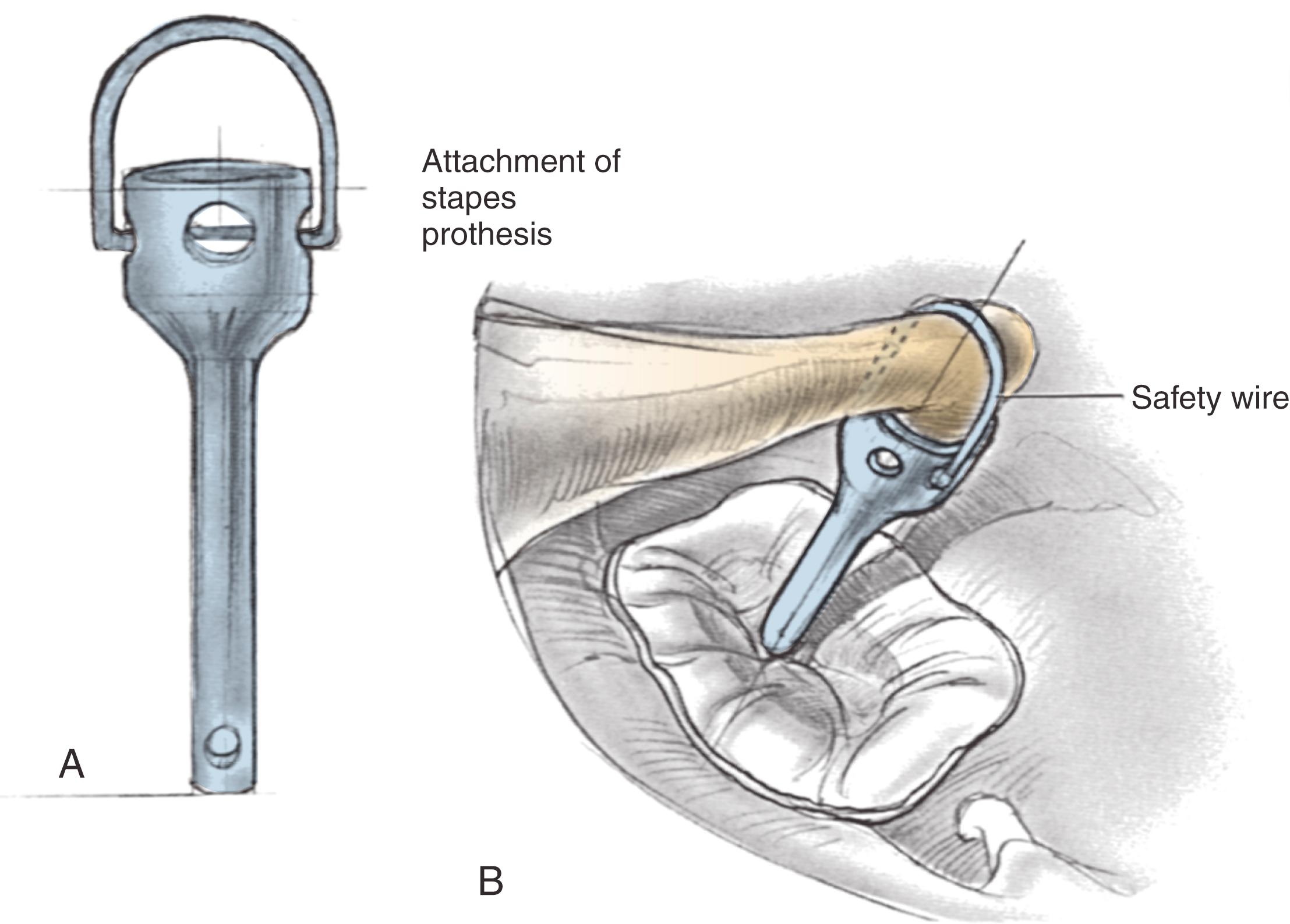 Partial Stapedectomy - Clinical Tree