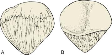 Patella Fractures and Extensor Mechanism Injuries - Clinical Tree