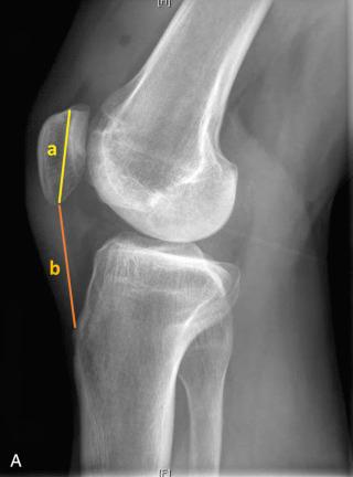 Patella Fractures and Extensor Mechanism Injuries - Clinical Tree