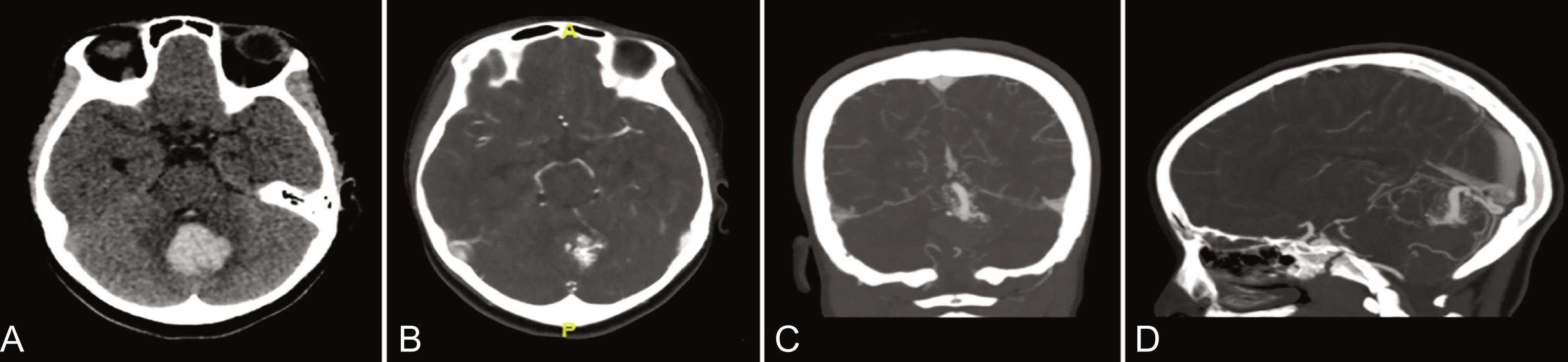 Pediatric AVMs - Clinical Tree