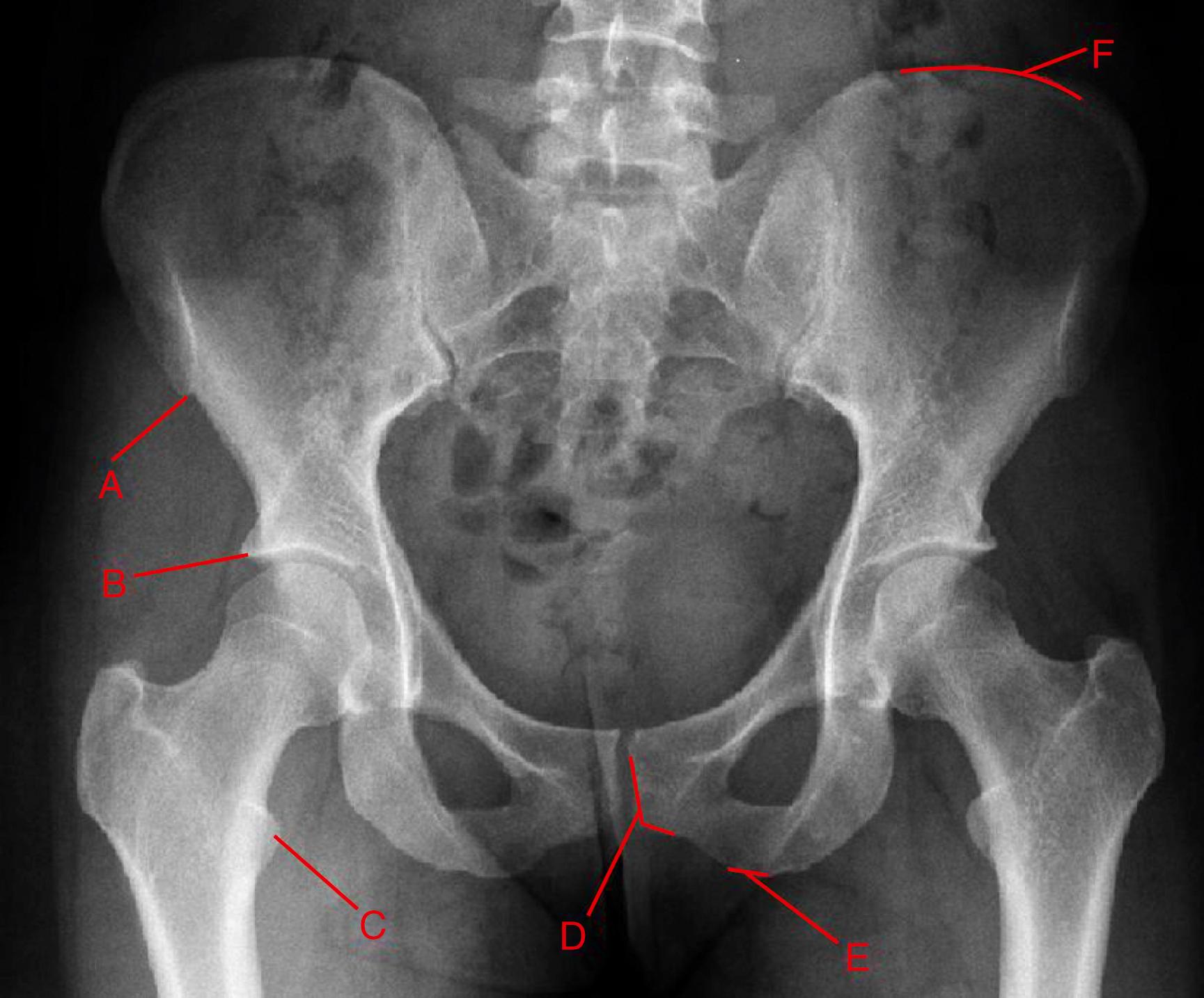 Pelvic Injuries - Clinical Tree