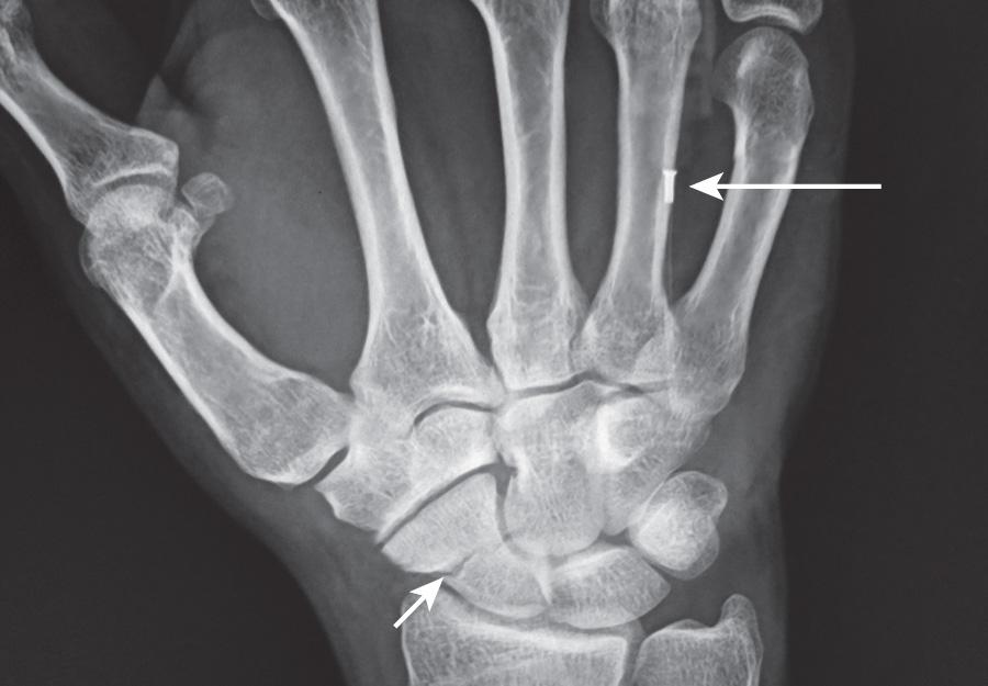 Peripheral Intravenous Access - Clinical Tree