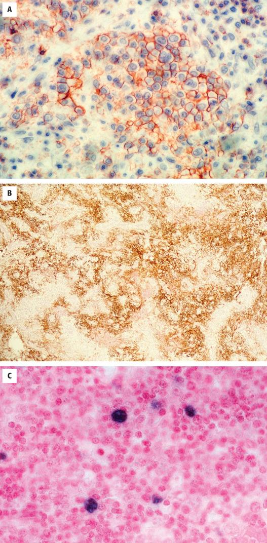 Peripheral T-Cell Lymphomas - Clinical Tree