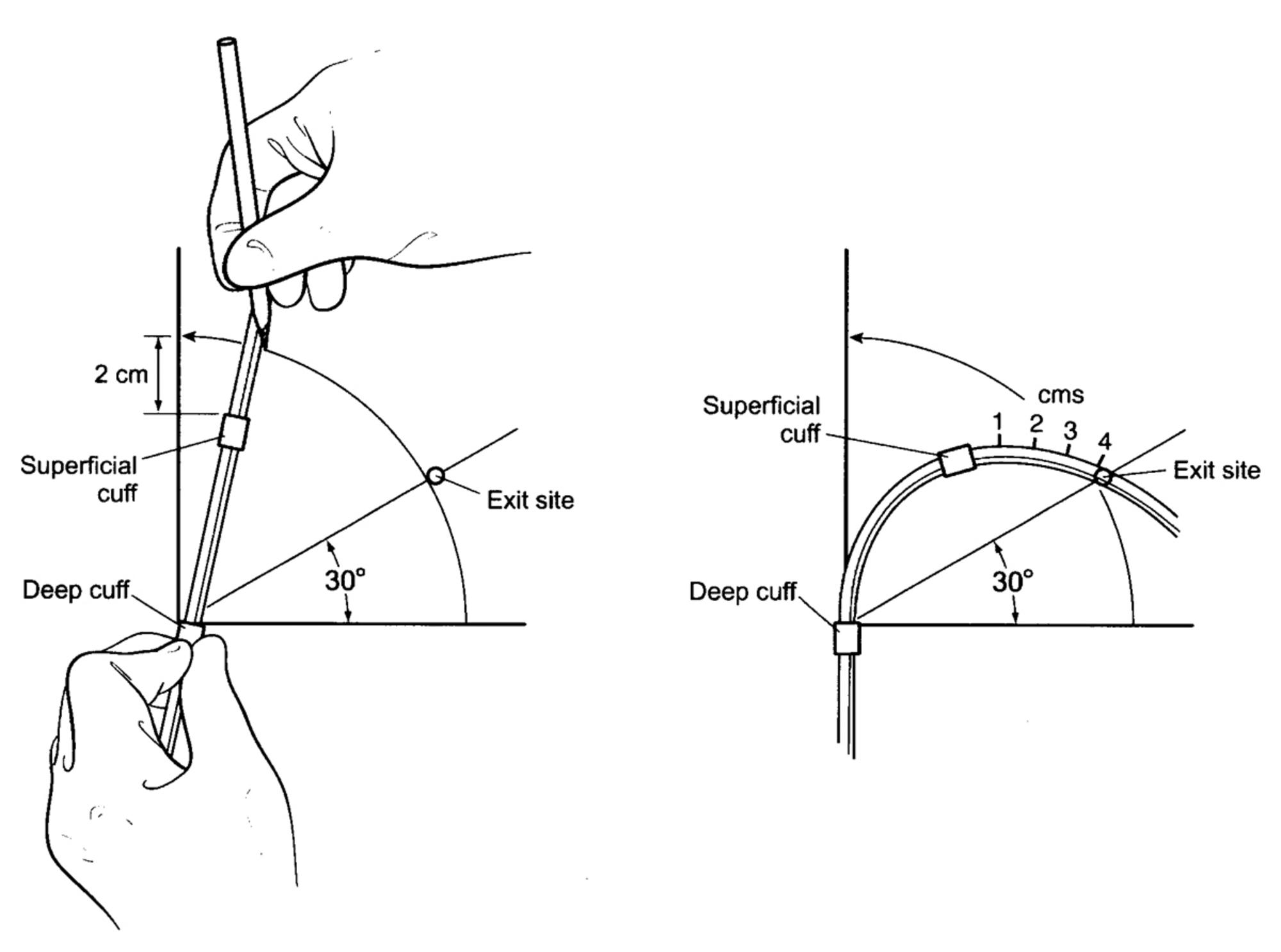 Peritoneal Access Devices, Placement Techniques, and Maintenance ...