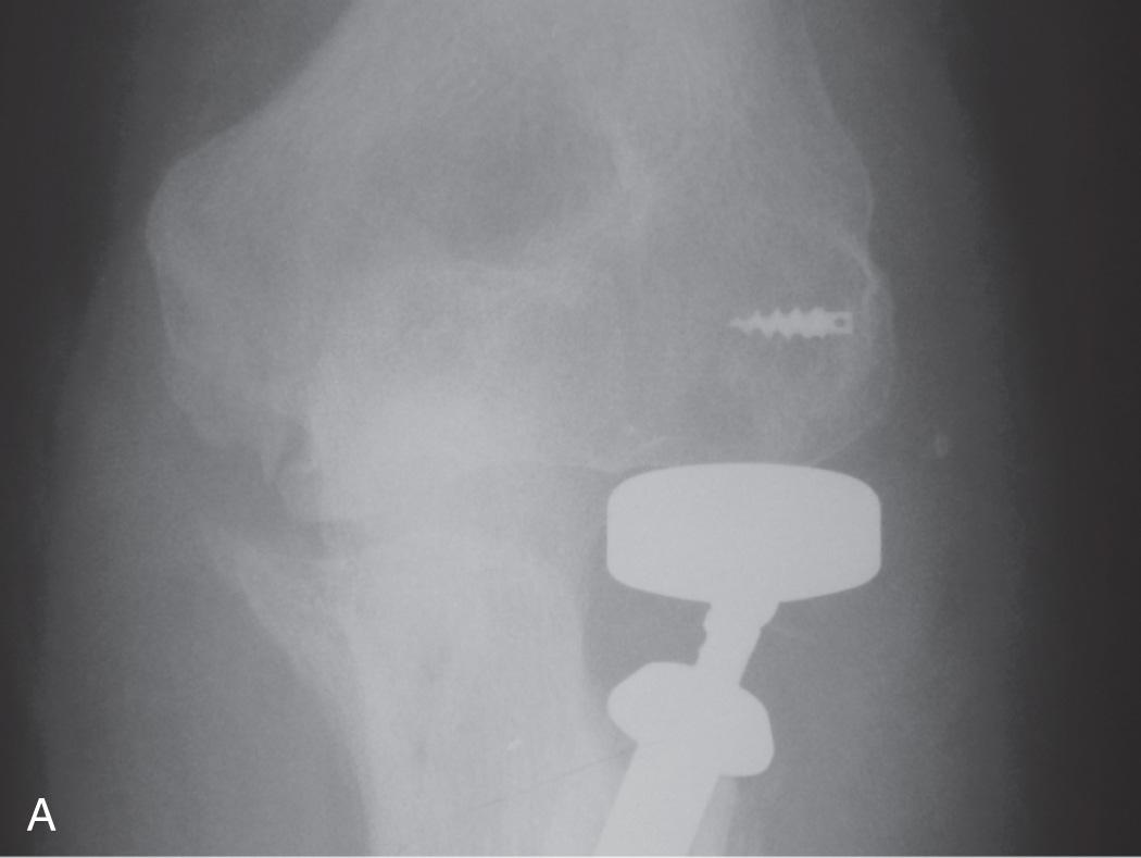Persistent Elbow Instability - Clinical Tree