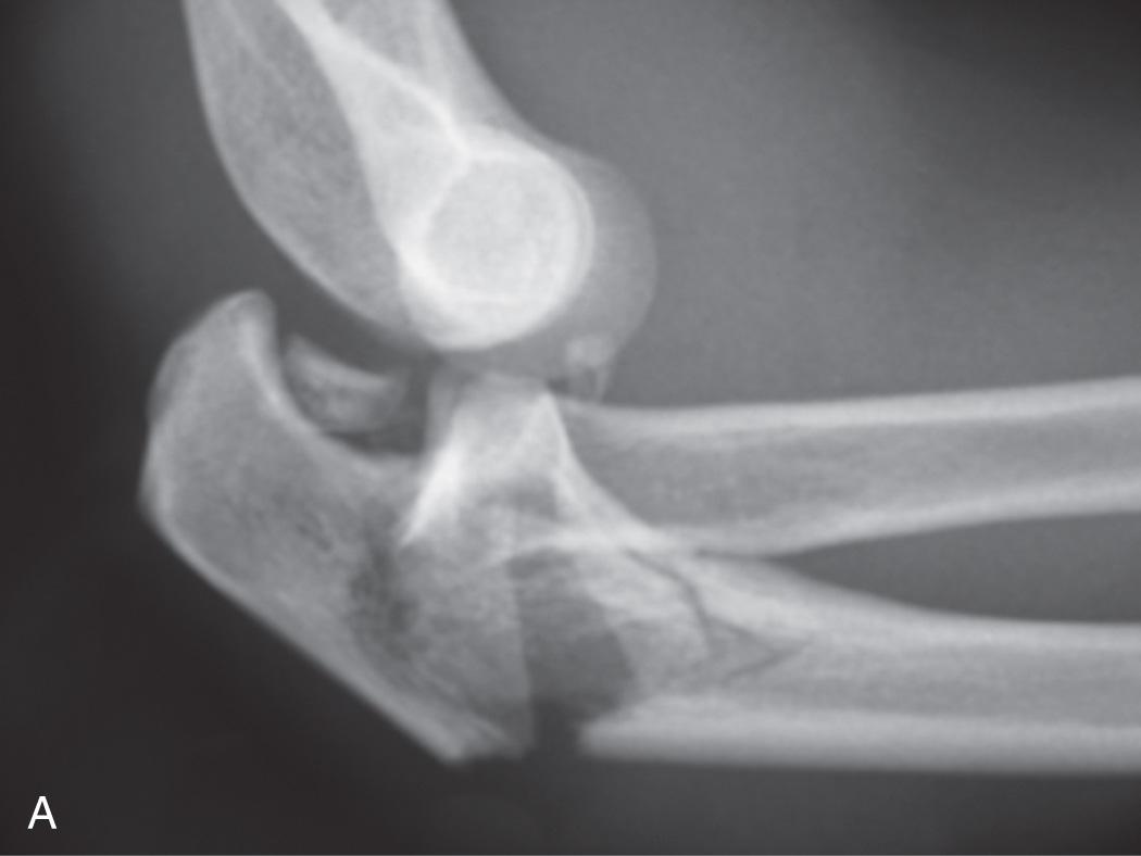 Persistent Elbow Instability - Clinical Tree
