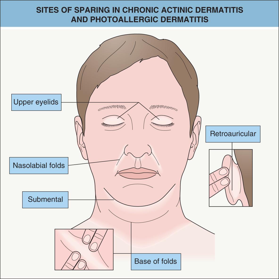 Photodermatologic Disorders - Clinical Tree