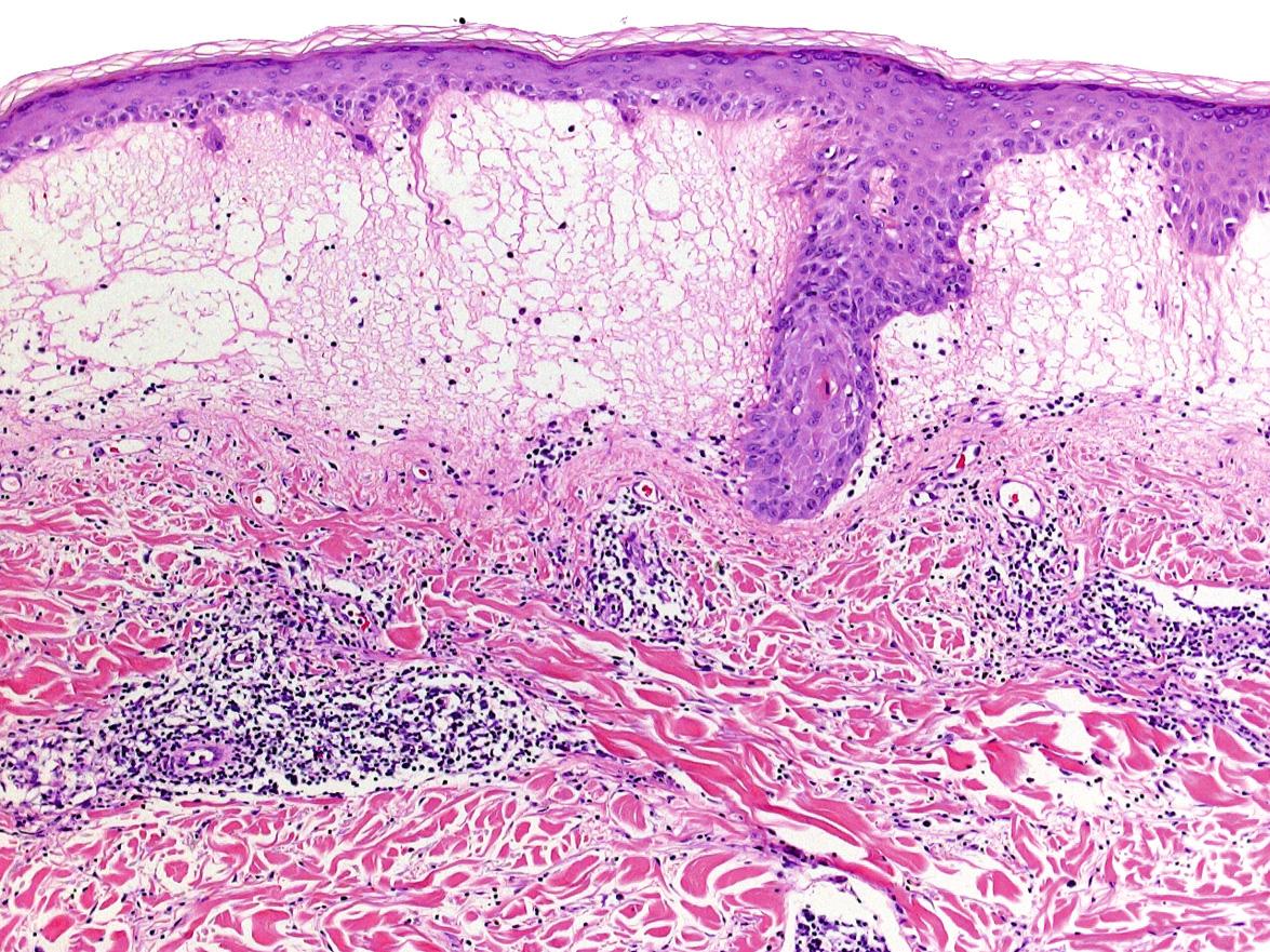 Photodermatologic Disorders - Clinical Tree