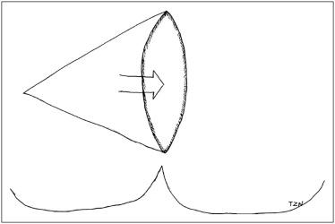 Pilonidal Cystectomy - Clinical Tree