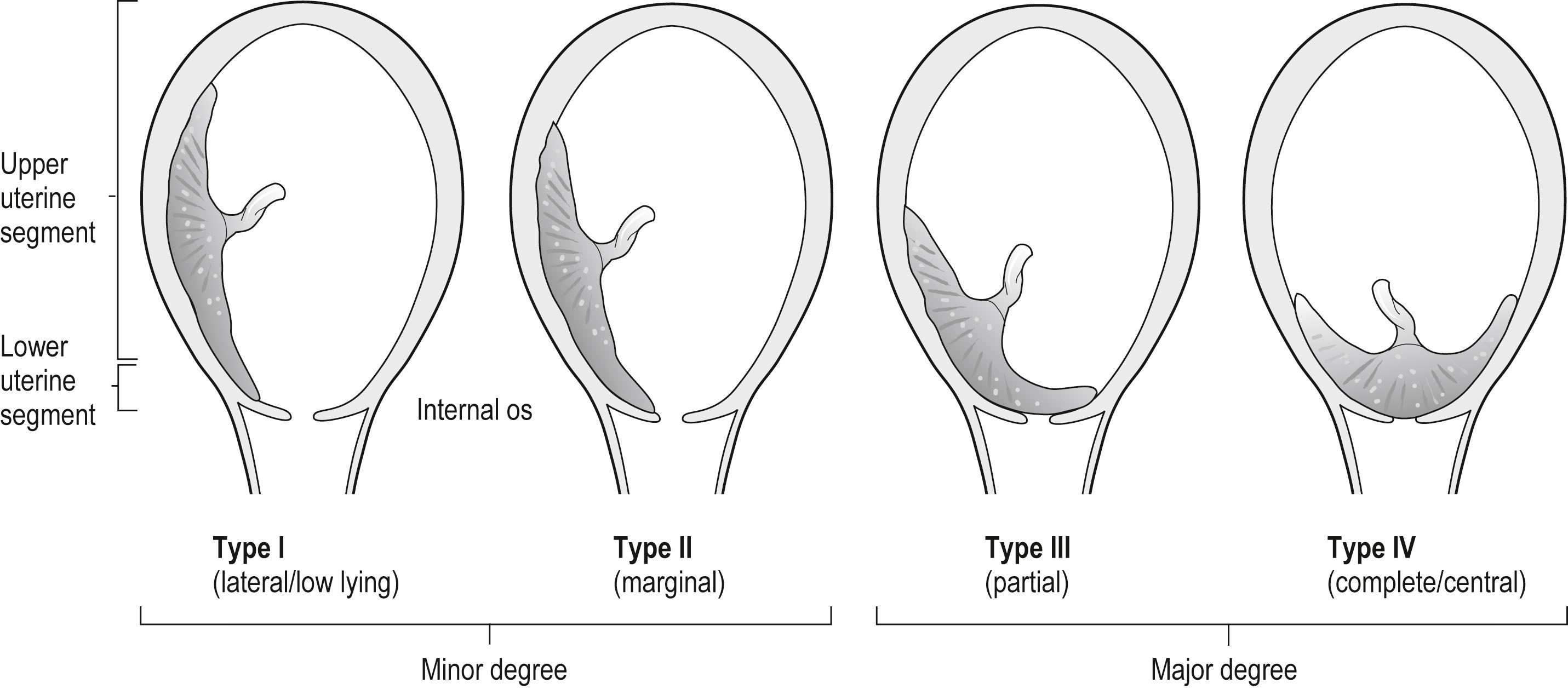 Placenta Praevia and the Placenta Accreta Spectrum - Clinical Tree