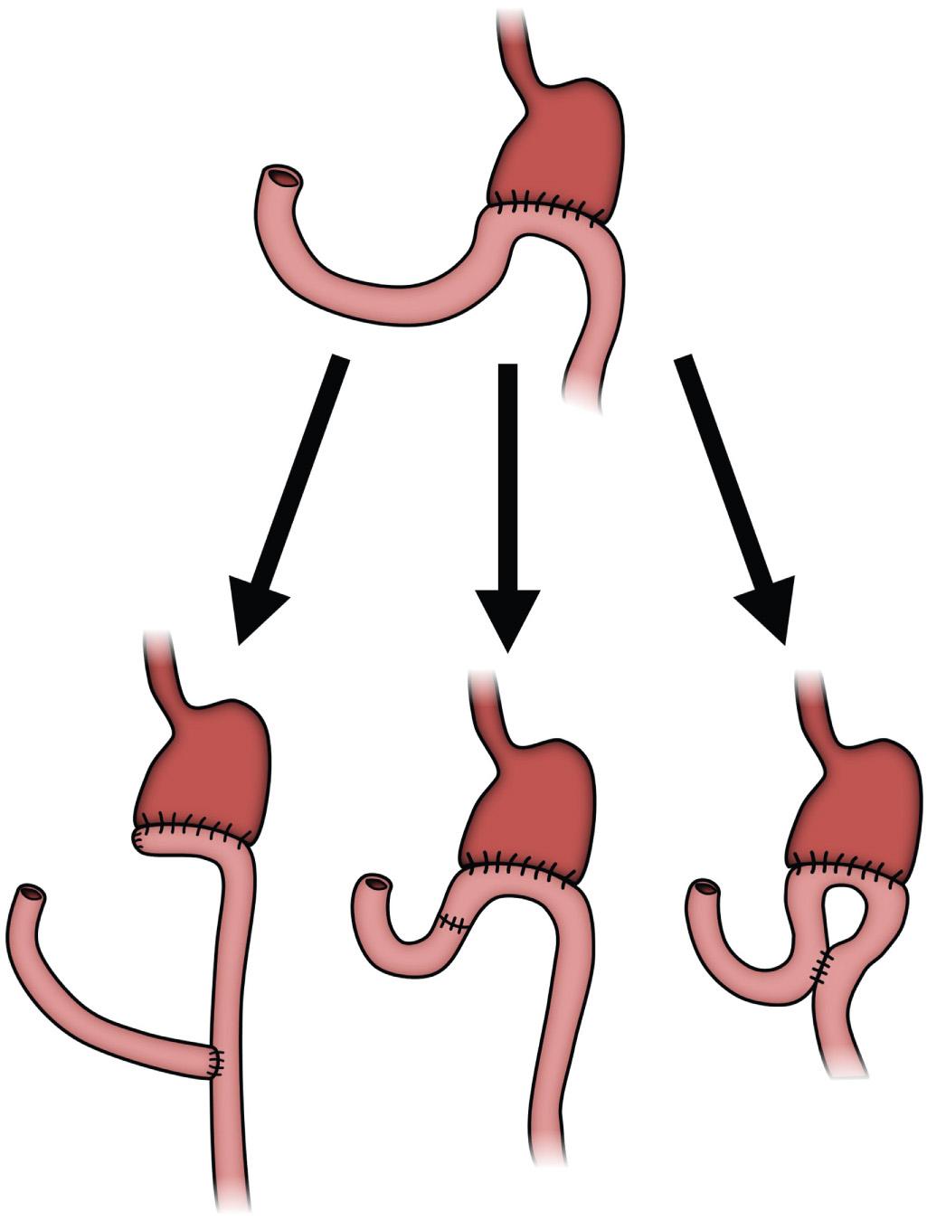Postgastrectomy Syndromes - Clinical Tree