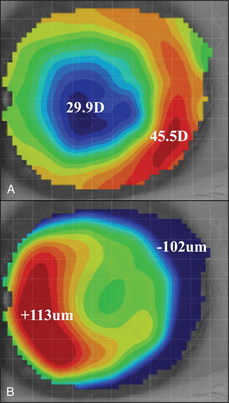 Post-refractive Surgery - Clinical Tree