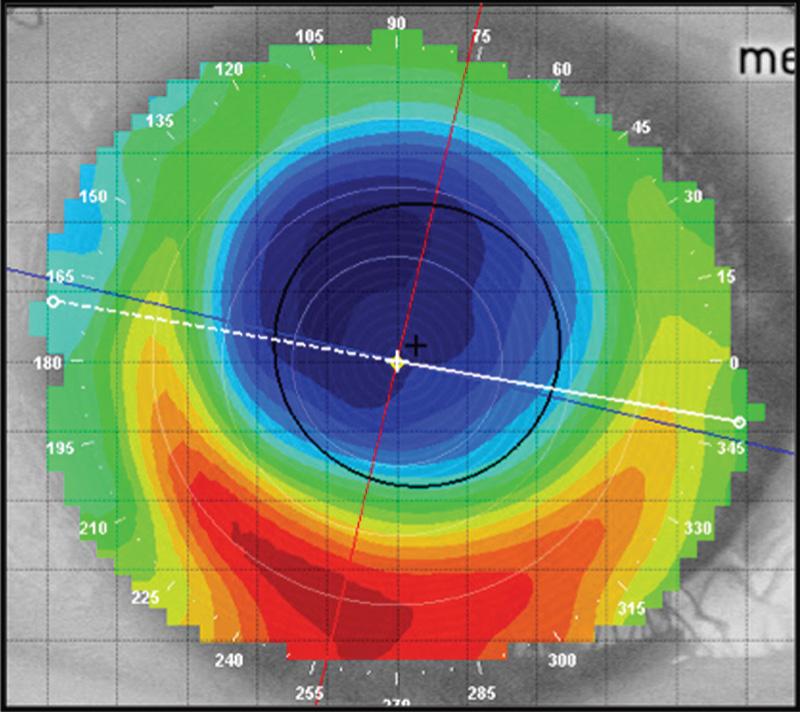 Post-refractive Surgery - Clinical Tree
