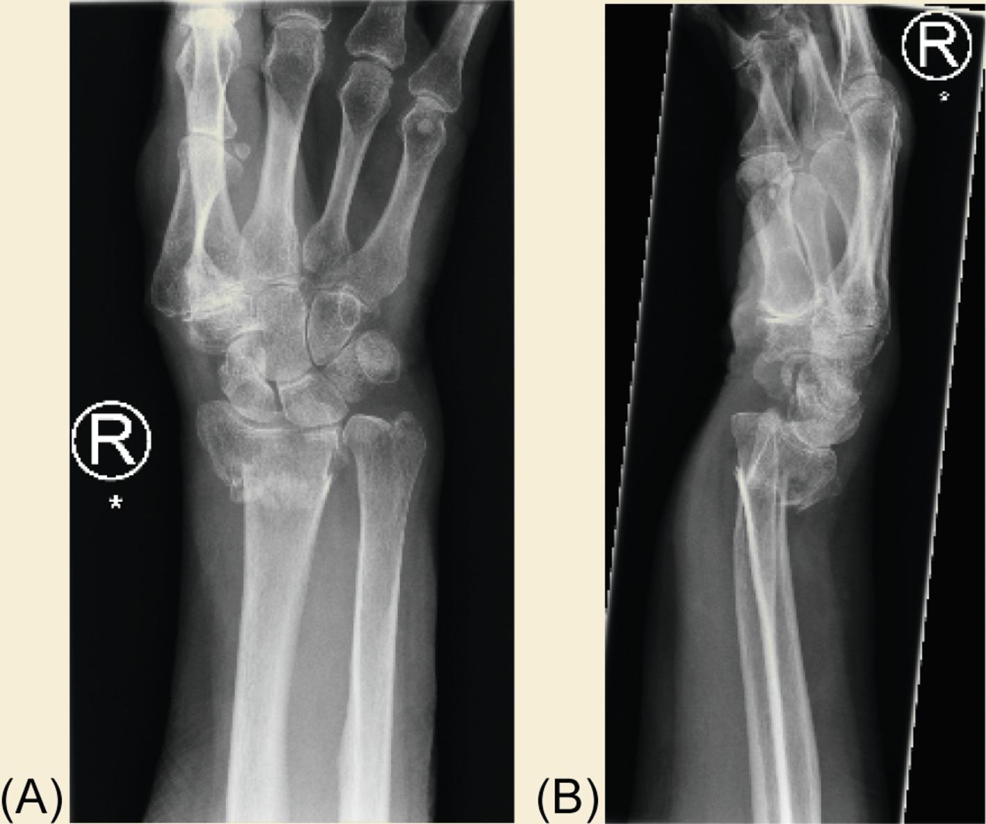 Predictors of Instability and Secondary Displacement After ...