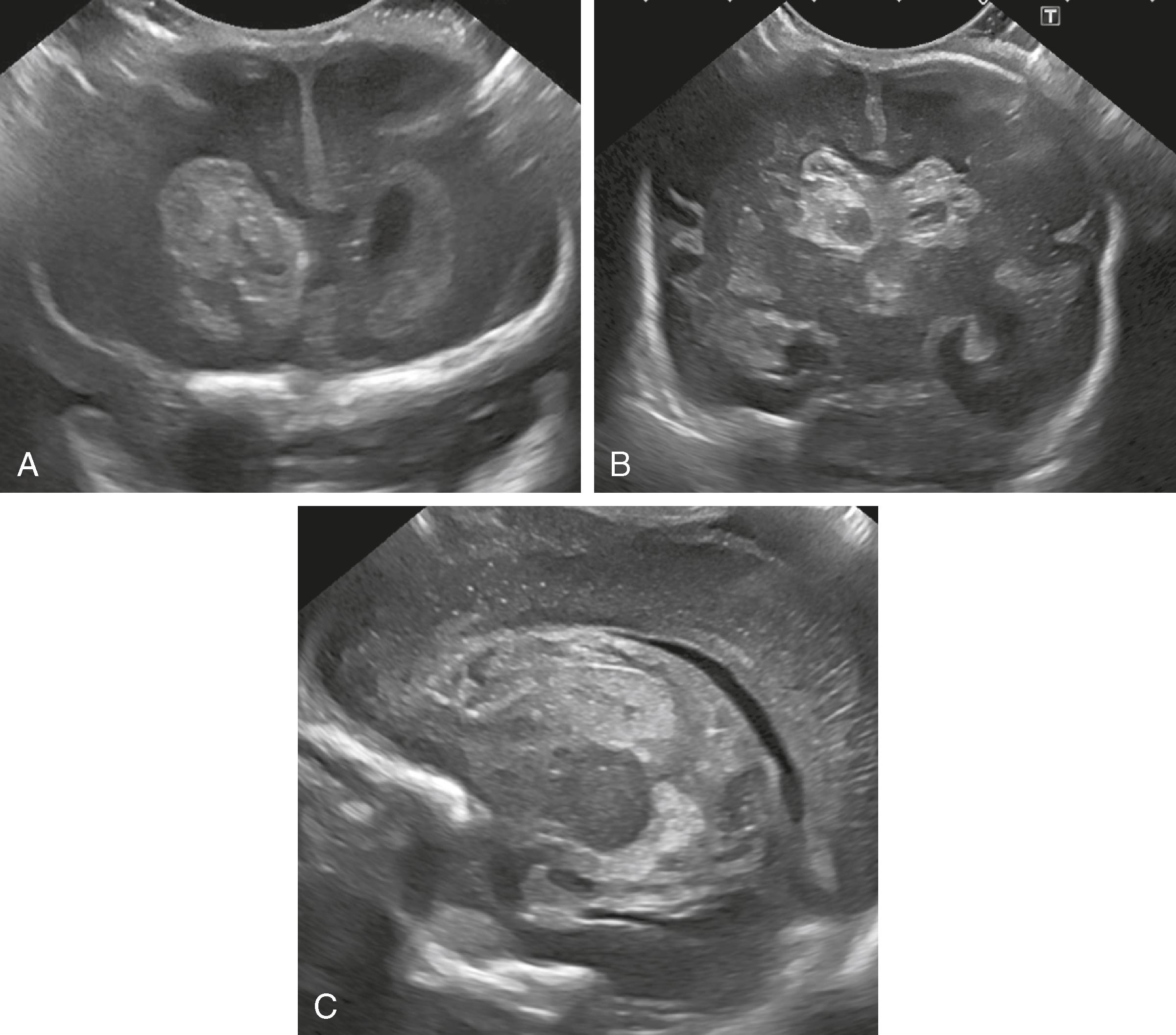 Prematurity And Abnormal Head Imaging - Clinical Tree