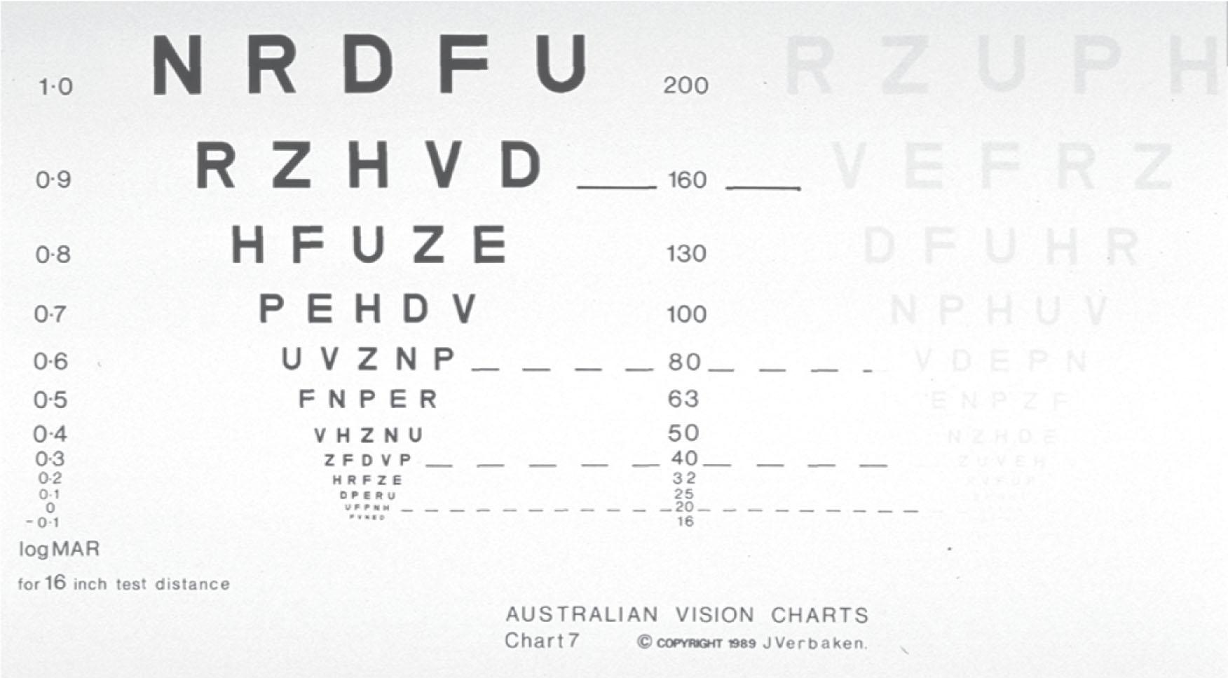 Presbyopia - Clinical Tree