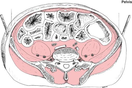 Principles and Complications of External Skeletal Fixation - Clinical Tree