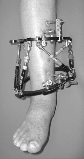 Principles and Complications of External Skeletal Fixation - Clinical Tree