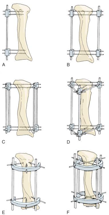 Principles and Complications of External Skeletal Fixation - Clinical Tree