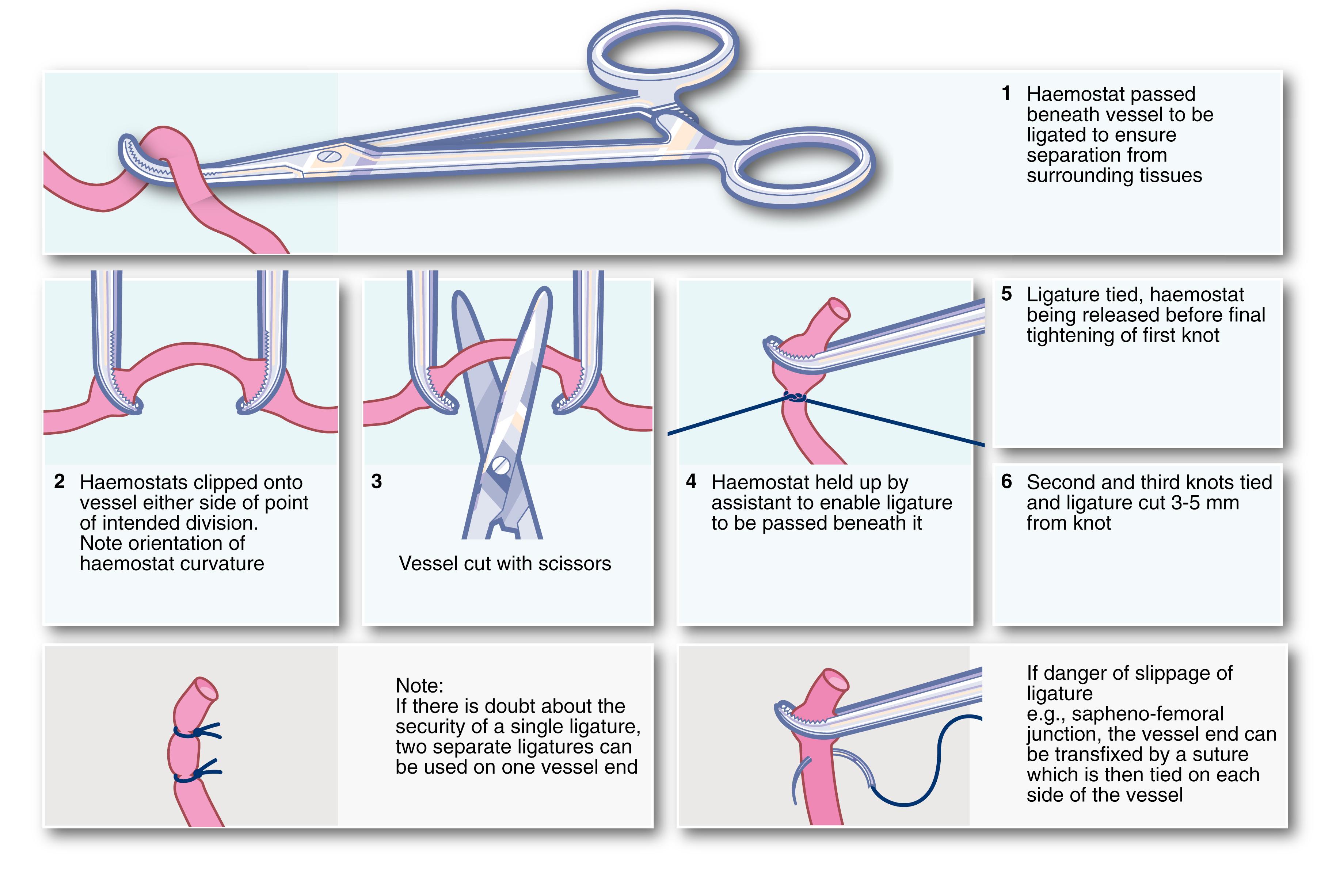 Principles and Techniques of Operative Surgery Including Neurosurgery ...