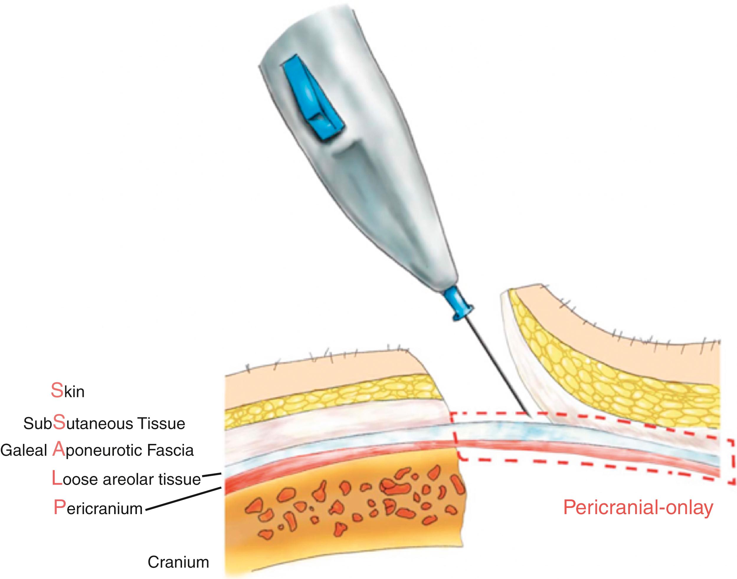 Principles of Neuroplastic Surgery: Management of Scalp Defects and ...