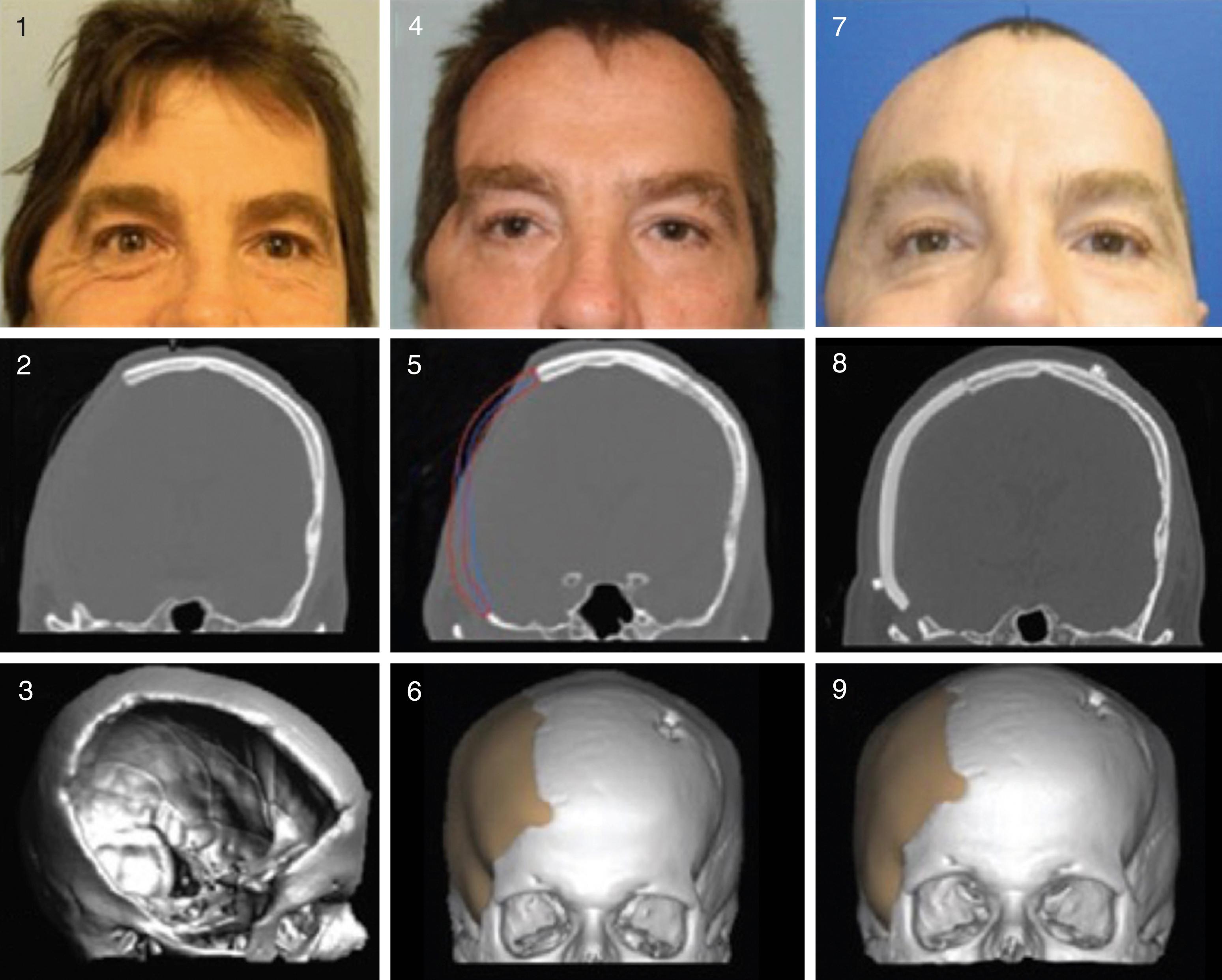 Principles of Neuroplastic Surgery: Management of Scalp Defects and ...