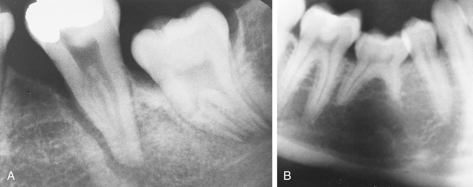 Principles of Routine Exodontia - Clinical Tree