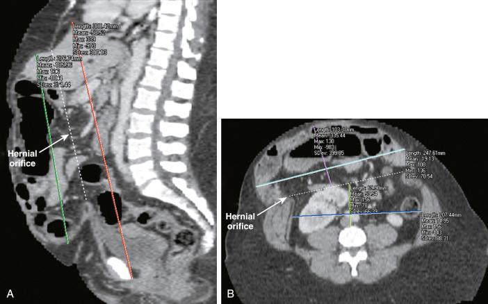 Progressive Preoperative Pneumoperitoneum For Hernias With Loss Of