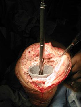 Prosthetic Augmentation - Clinical Tree