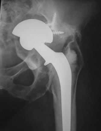 Protrusio Acetabuli - Clinical Tree