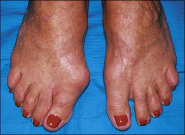 Proximal Long Oblique (Ludloff) First Metatarsal Osteotomy With Distal ...