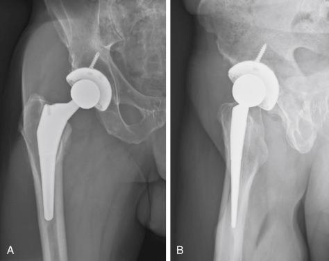 Proximal Porous-Coated Modular Stems: Surgical Technique - Clinical Tree