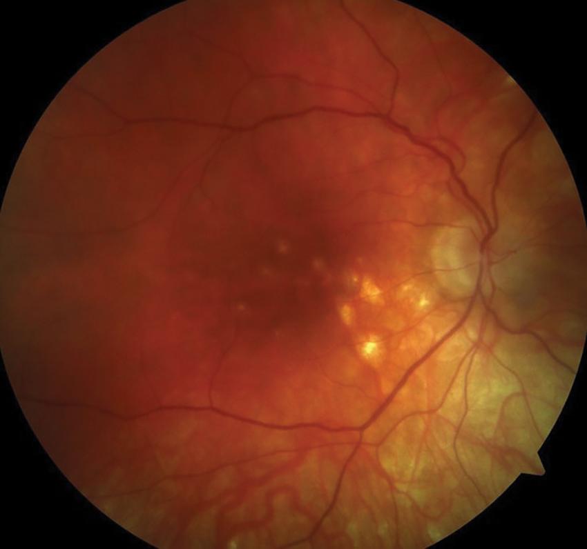 Punctate Inner Choroidopathy (PIC) - Clinical Tree