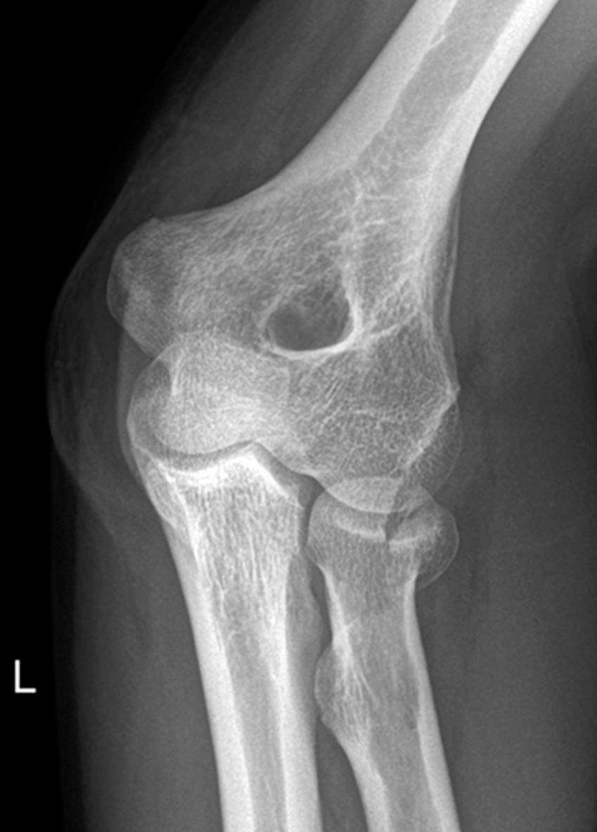Radial Head Fracture: Open Reduction and Internal Fixation - Clinical Tree