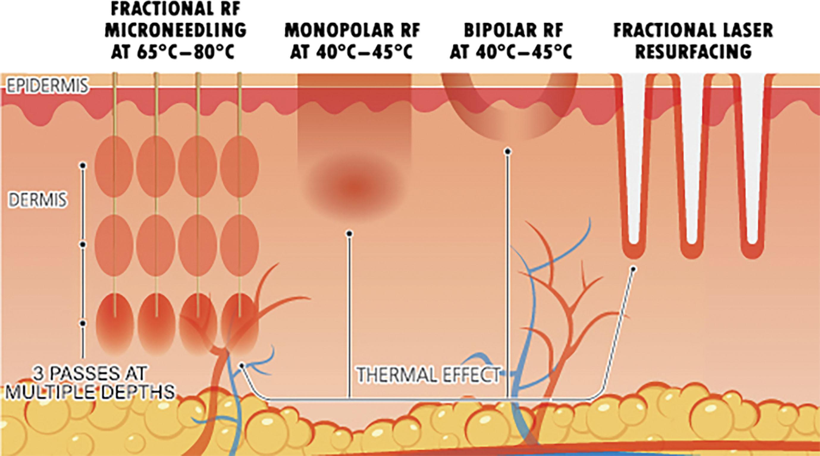 Radiofrequency Microneedling - Clinical Tree