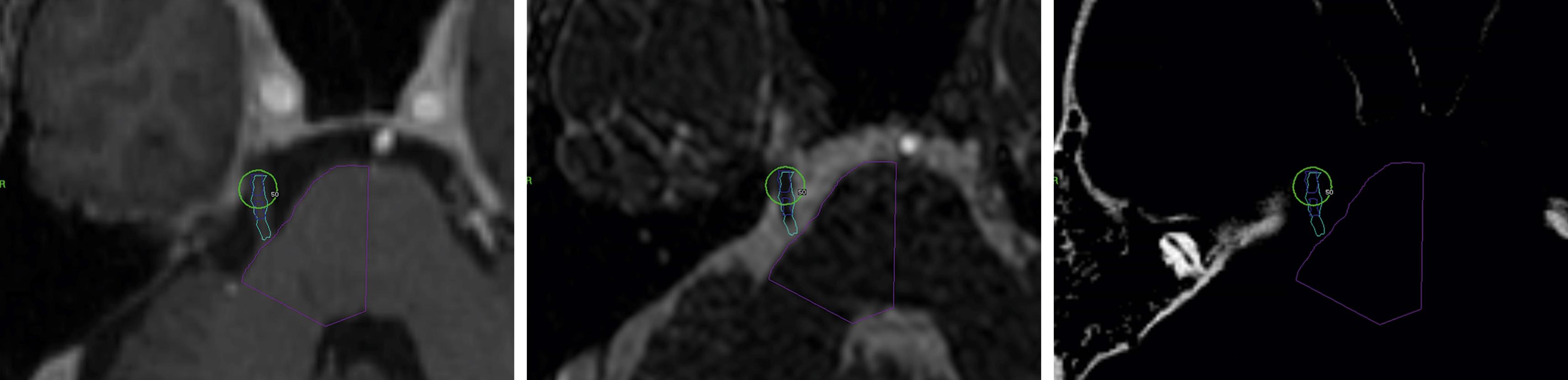 Radiosurgery for Functional Disorders and Epilepsy - Clinical Tree